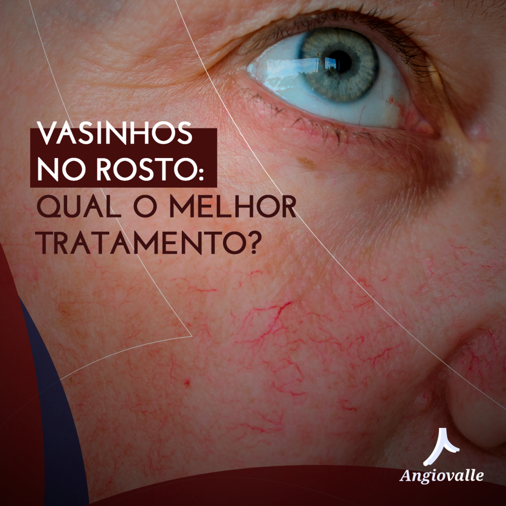 Vasinhos no rosto qual o melhor tratamento? - AngioViva