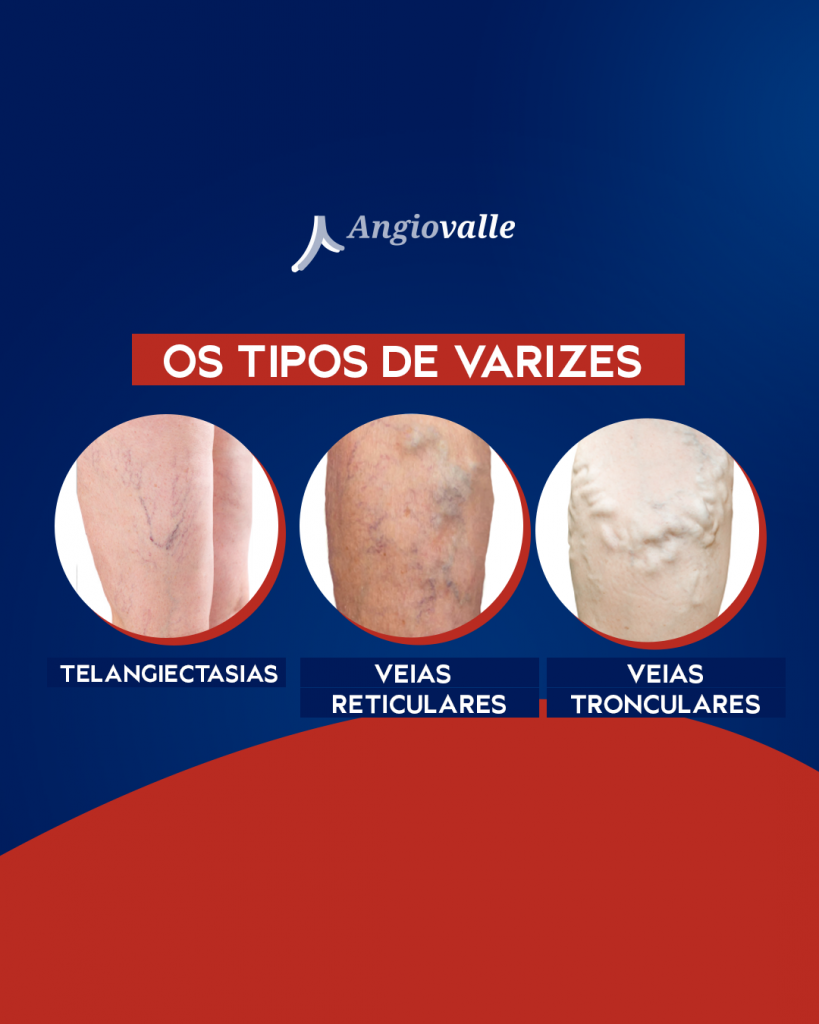 Conheça os tipos de varizes - AngioViva