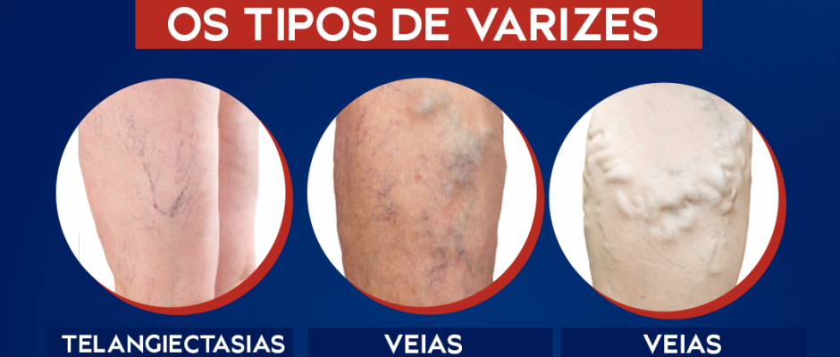 Conheça os tipos de varizes - AngioViva